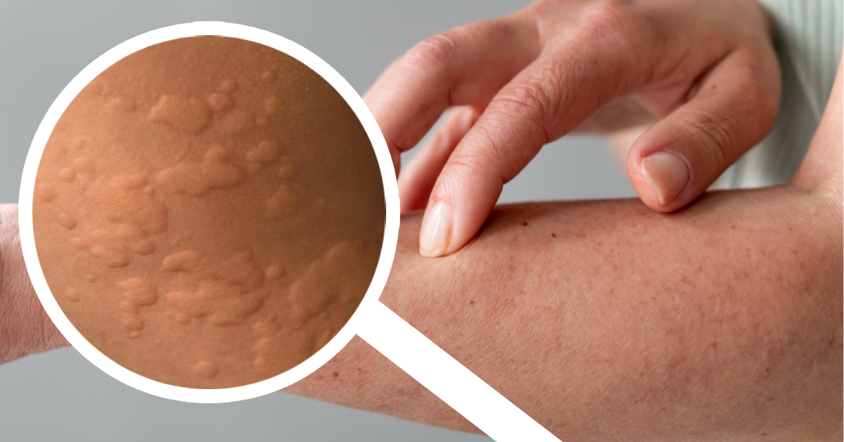 Koprivnjača - Health Medic